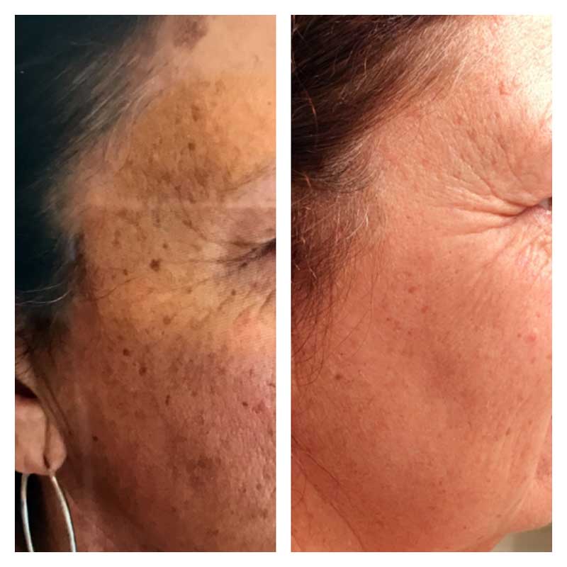 BBL™ - BroadBand Light - Postiche